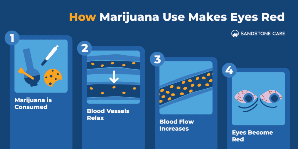 High Eyes | Causes, Symptoms, and How to Address Them