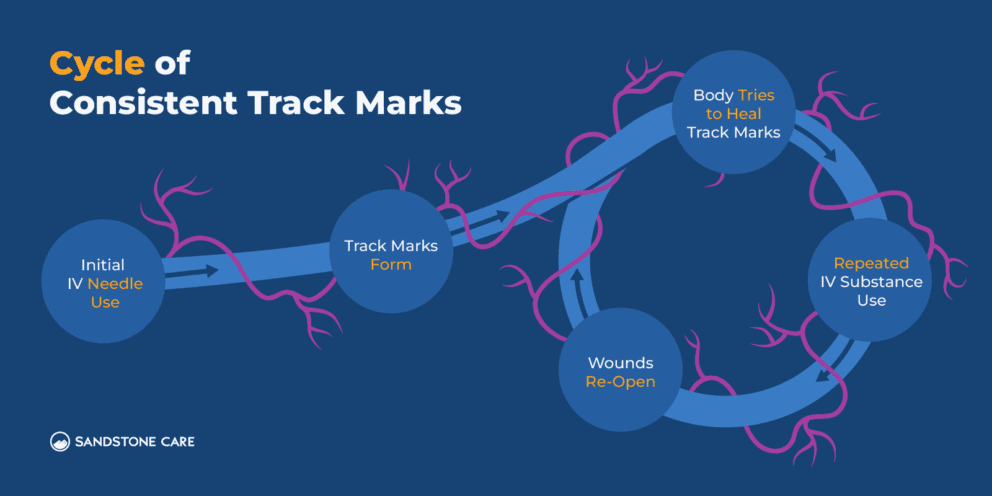 Track Marks | What They Look Like and How to Recover